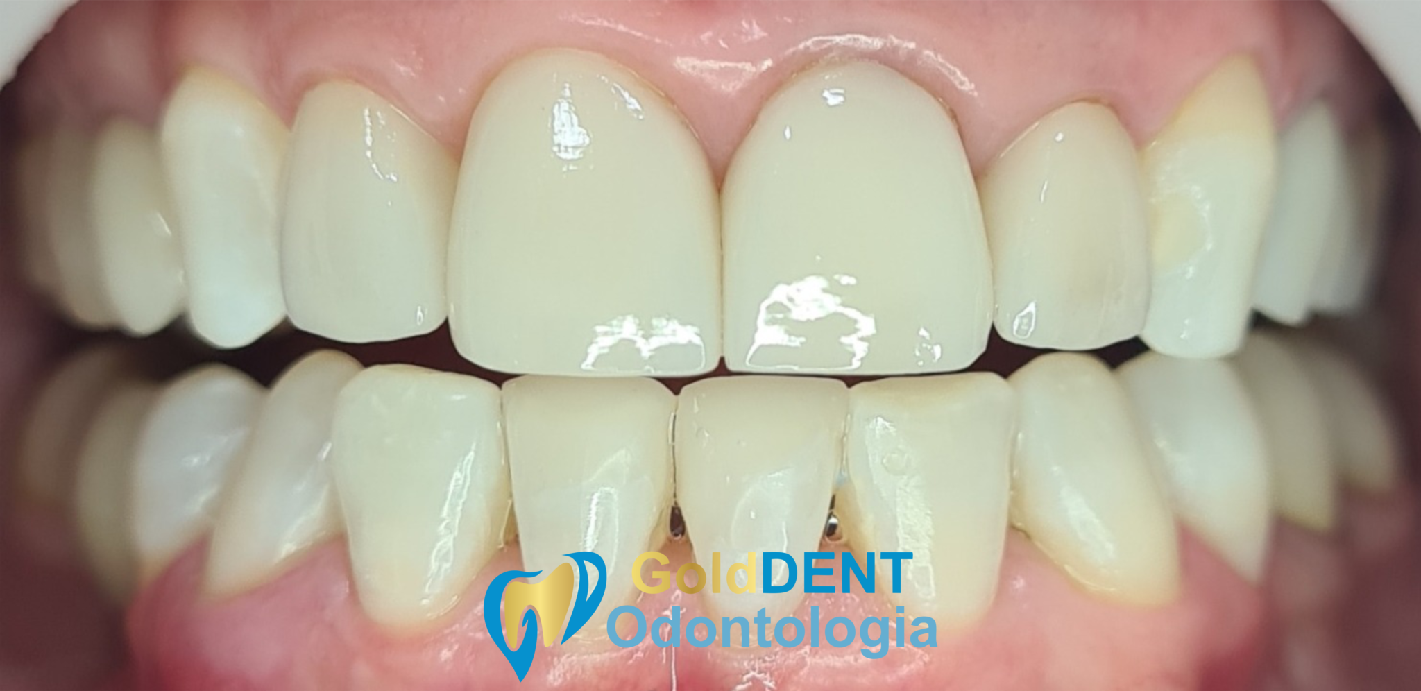 Dentes com bordos fraturados - Gold Dent Clínica Odontológica.